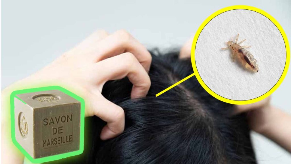 Les poux : le remède naturel pour s'en débarrasser une fois pour toutes